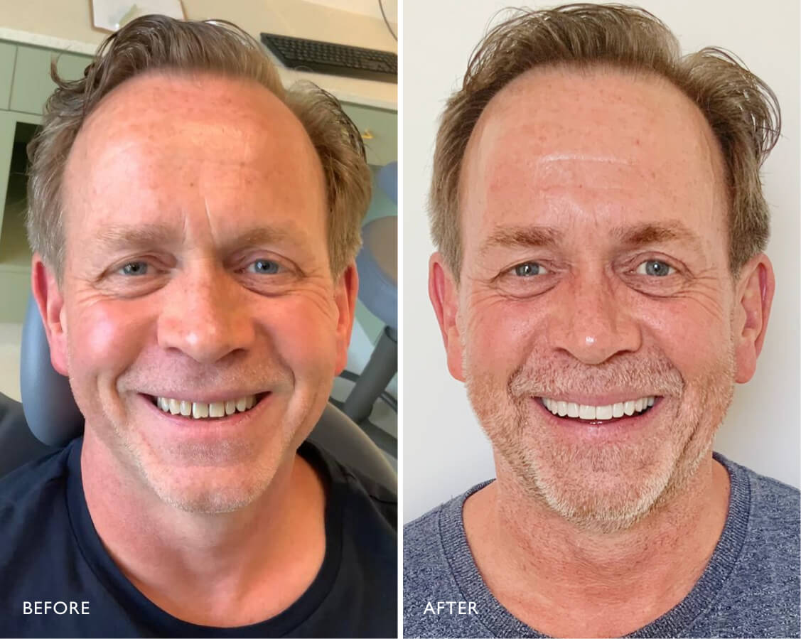 Dental Implants Bentleigh | Dental + Skin Clinic VIC 3165