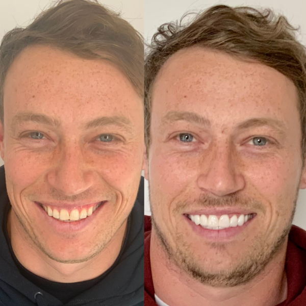 Types of Veneers: Comparing Benefits, Suitability & Costs