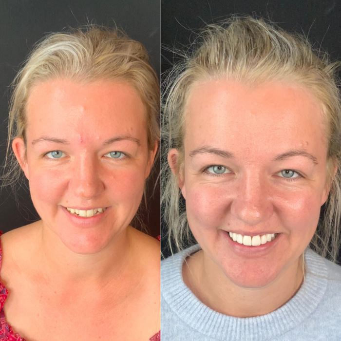 Types of Veneers: Comparing Benefits, Suitability & Costs